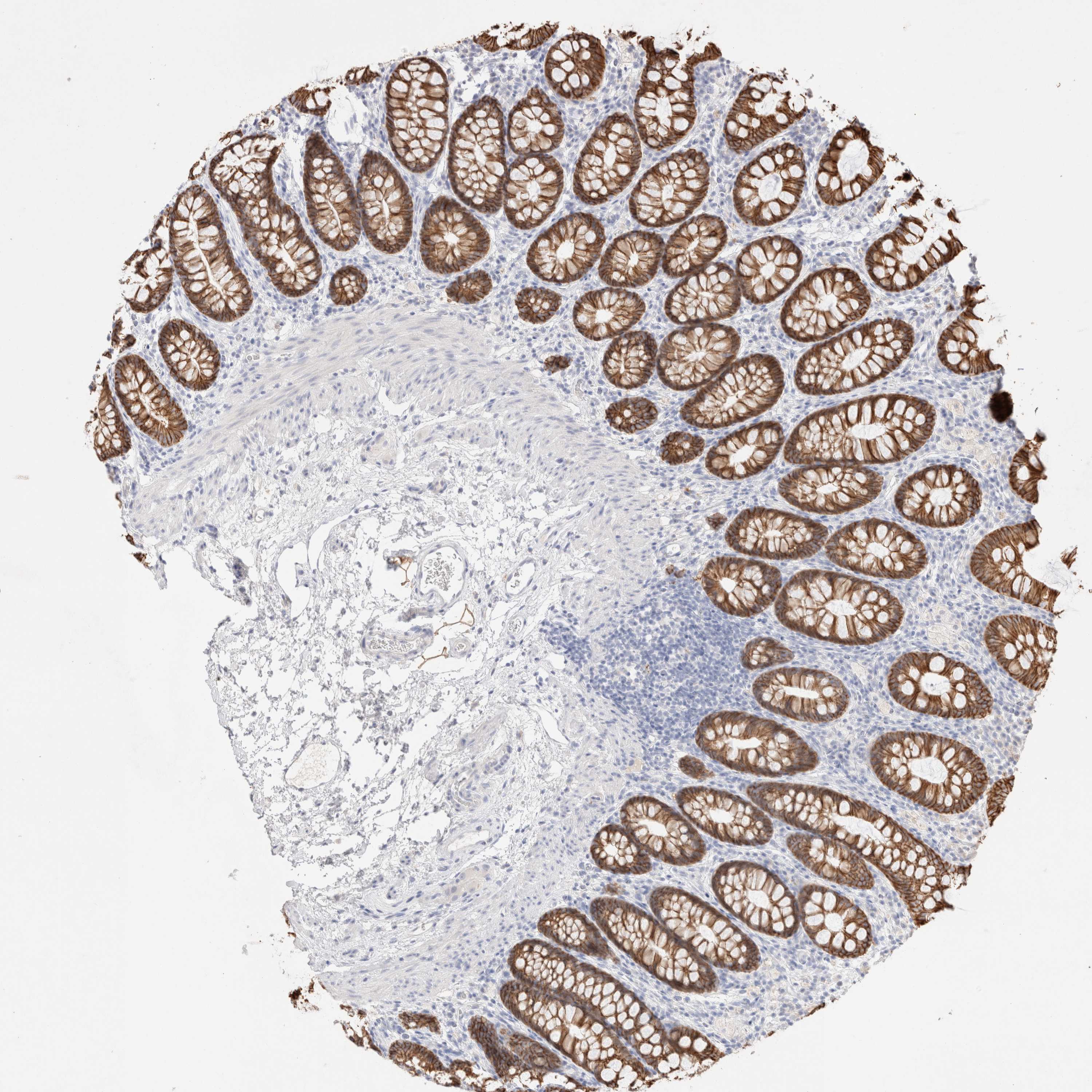 Tissue Expression Of Epcam Staining In Colon The Human Protein Atlas