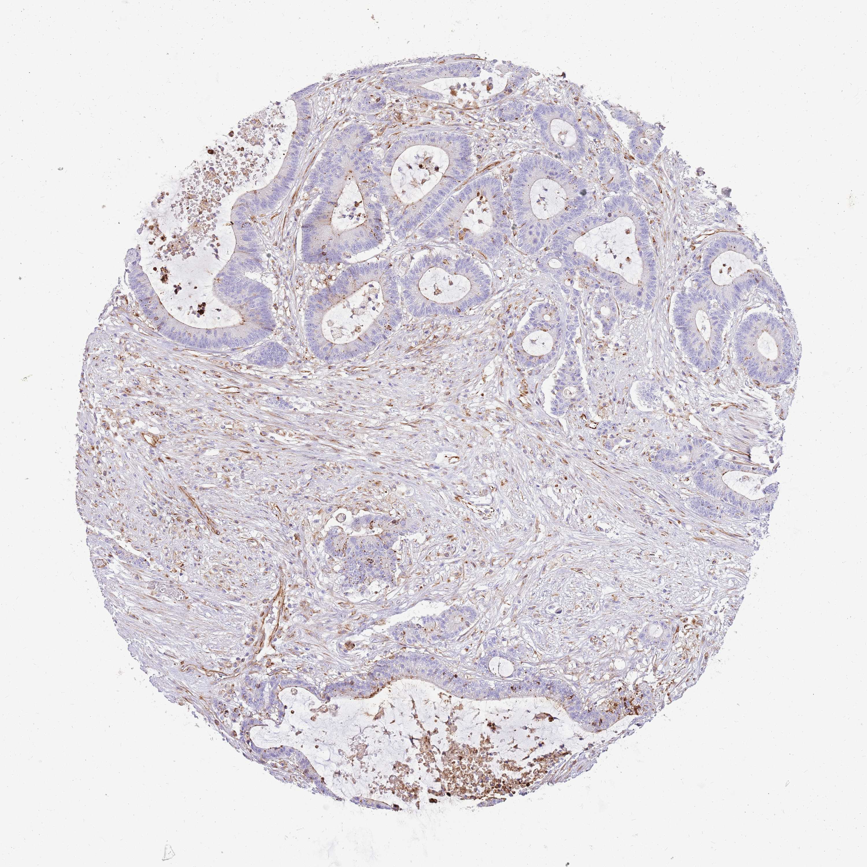Expression of ZDHHC1 in colorectal cancer - The Human Protein Atlas