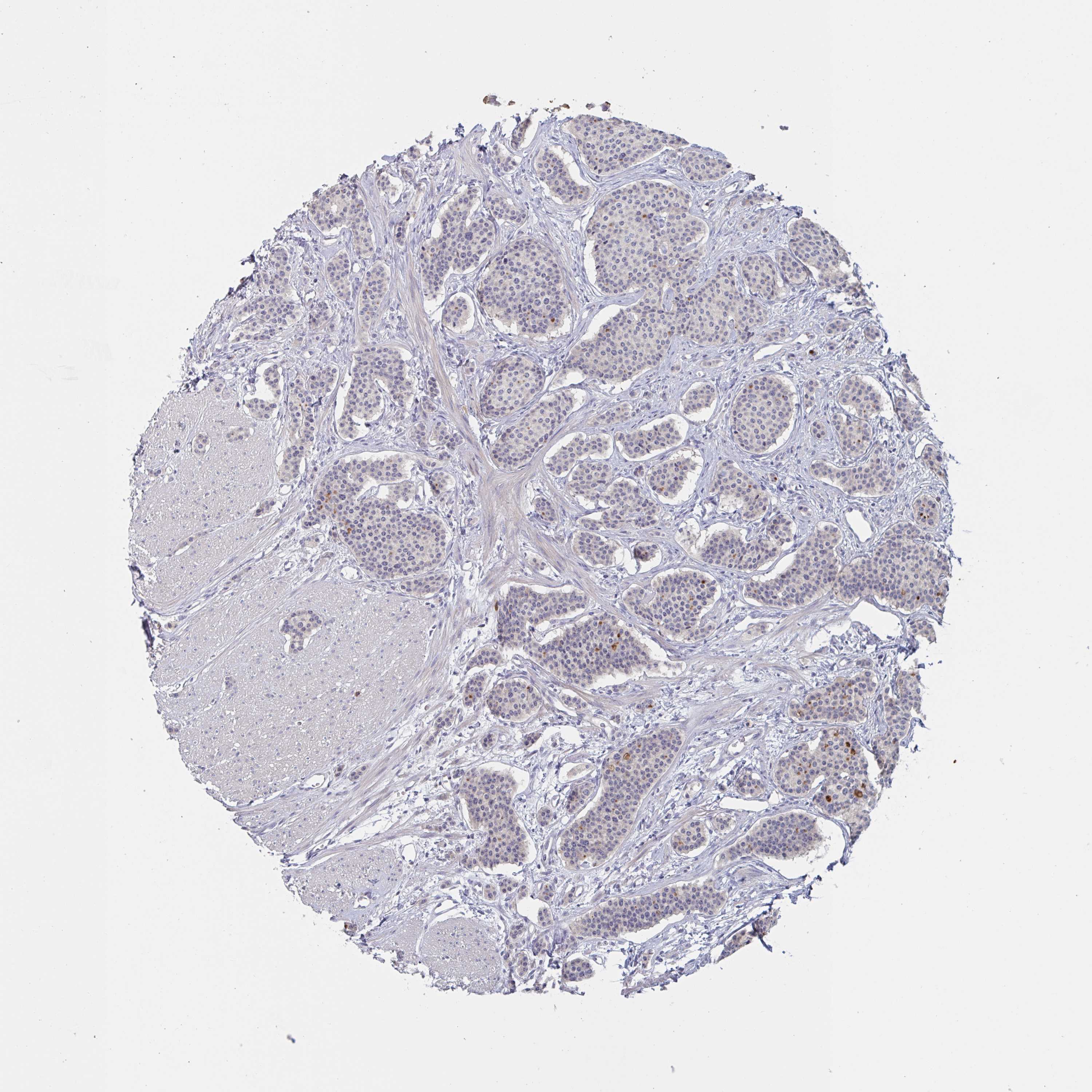 Expression Of St14 In Carcinoid The Human Protein Atlas