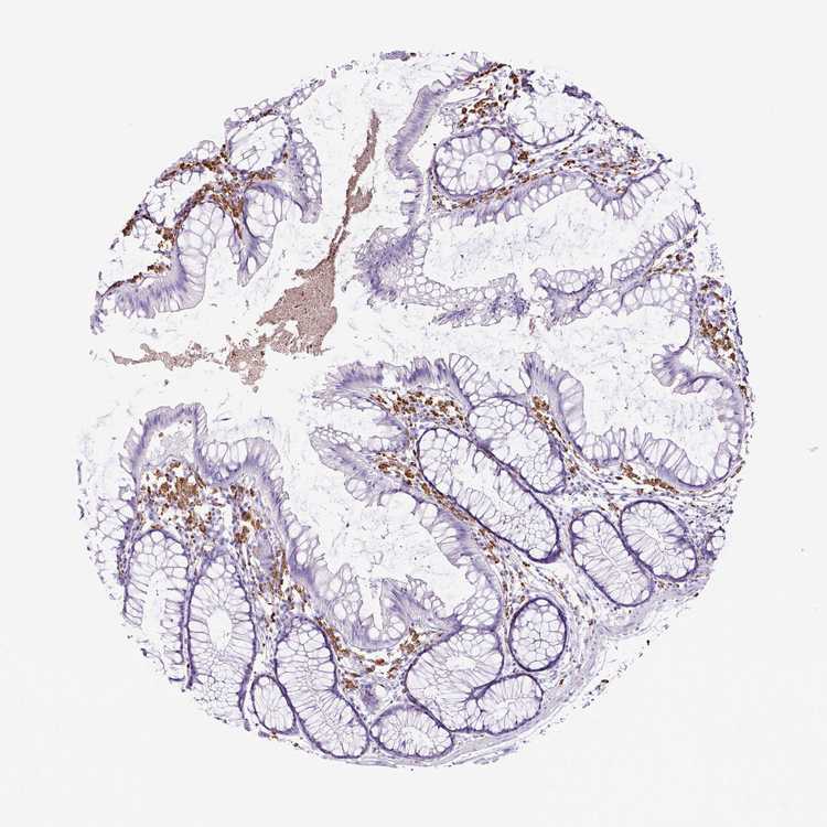 Tissue Expression Of Cd68 Staining In Colon The Human Protein Atlas