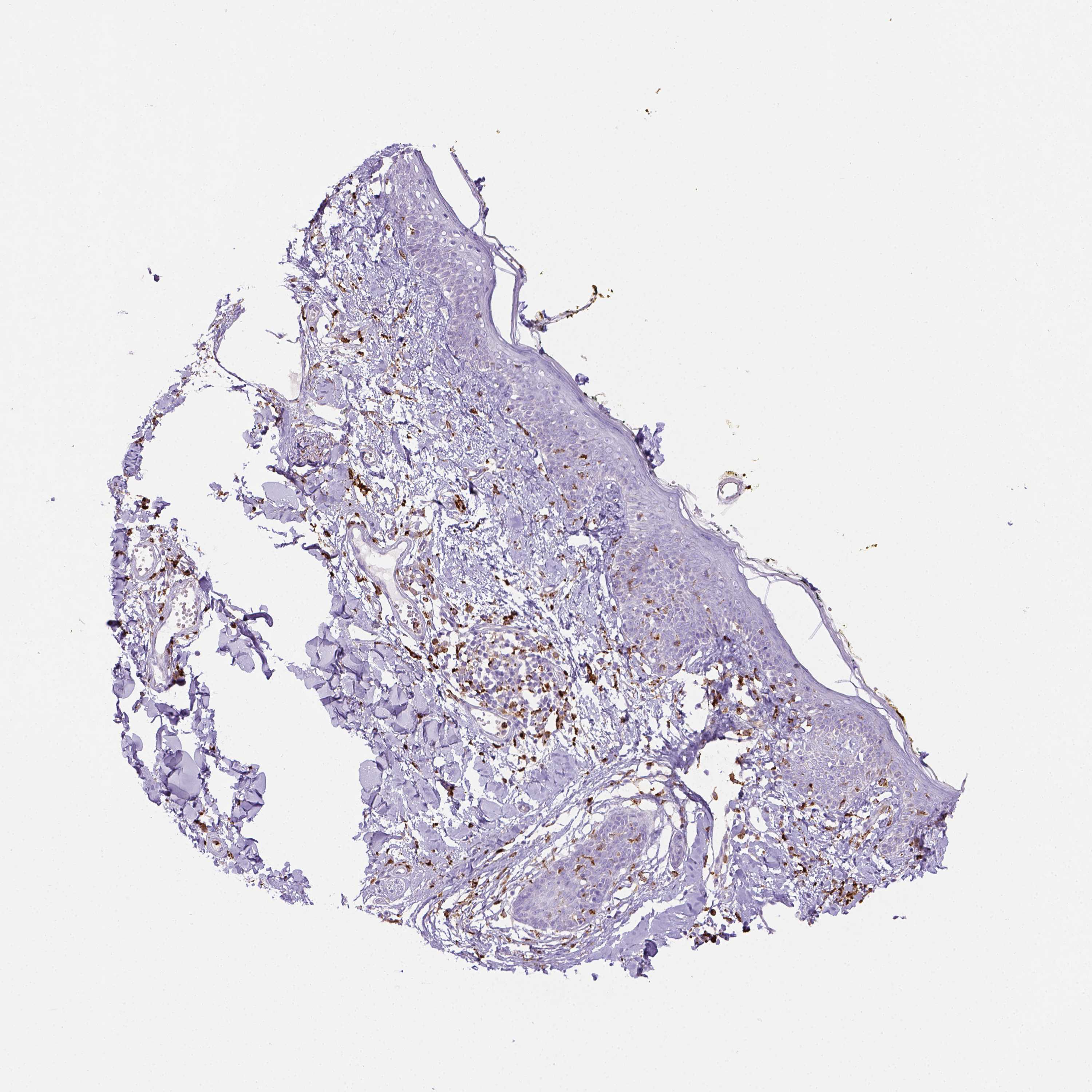 Tissue Expression Of Cd68 Staining In Skin The Human Protein Atlas
