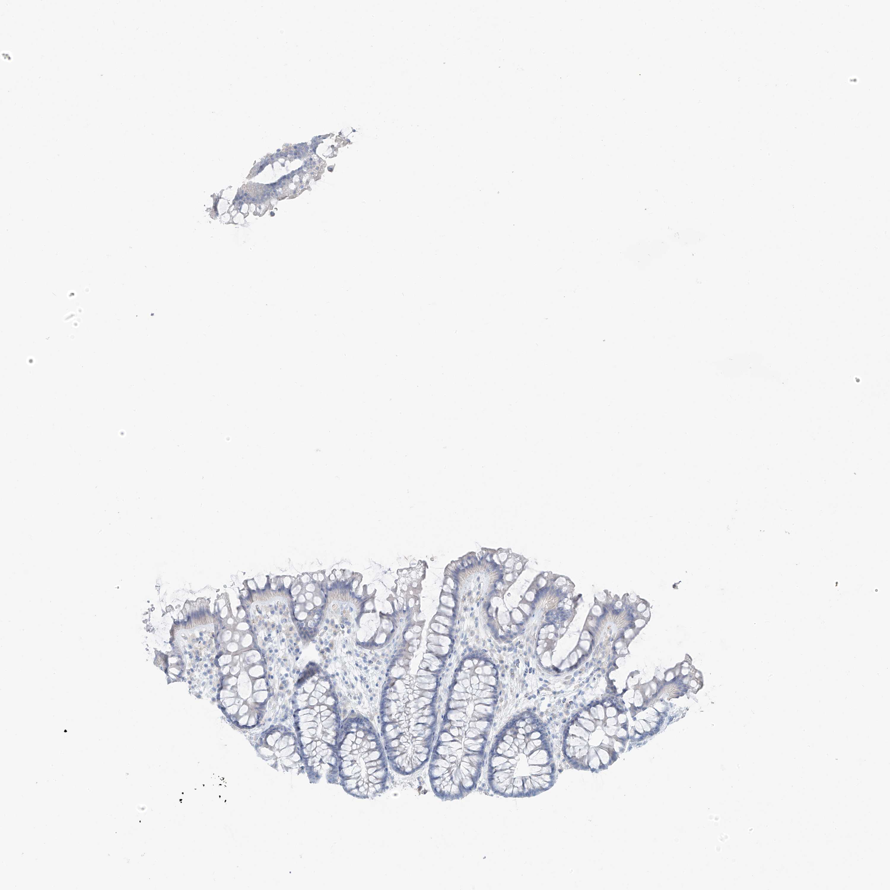 Tissue Expression Of Pdgfc Staining In Colon The Human Protein Atlas